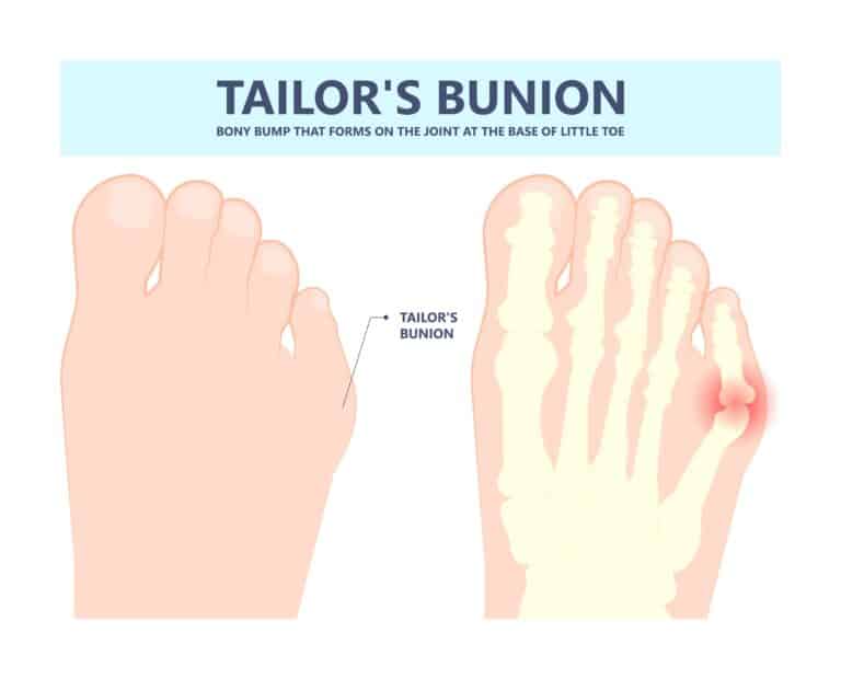 Tailor's Bunion - Orthopedic Solutions OKC